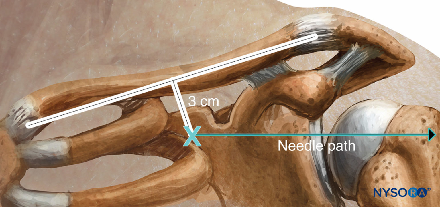 Infraclavicular Brachial Plexus Block - Landmarks and Nerve Stimulator ...