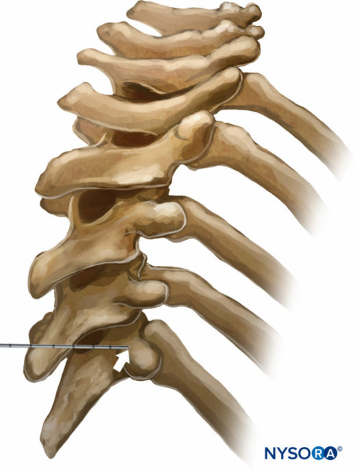 Thoracic and Lumbar Paravertebral Block - Landmarks and Nerve ...