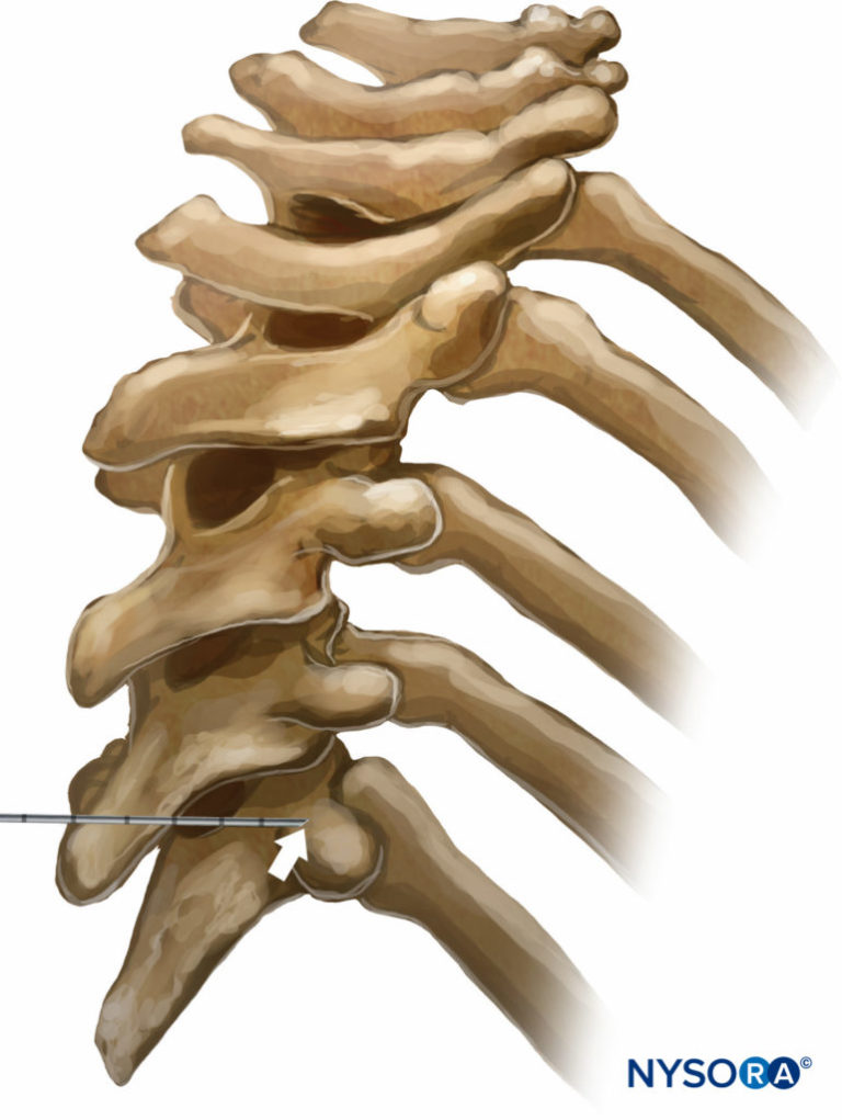 Thoracic and Lumbar Paravertebral Block - Landmarks and Nerve ...