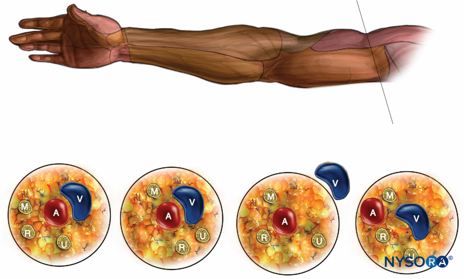Axillary Brachial Plexus Block - Landmarks and Nerve Stimulator ...