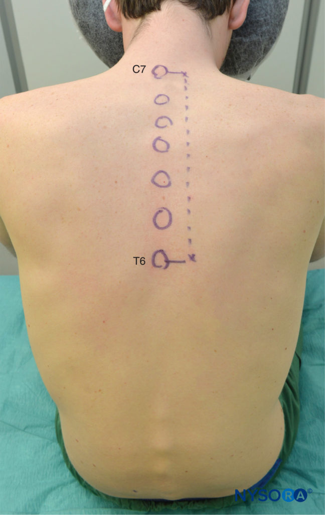 regional-anesthesia-surface-landmarks-thoracic-paravertebral-blocks ...