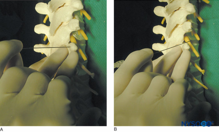 Thoracic and Lumbar Paravertebral Block - Landmarks and Nerve ...