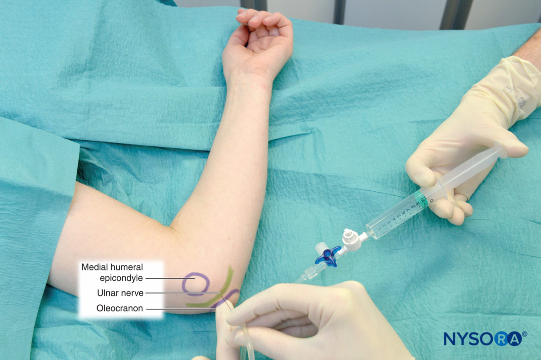 Regional Anesthesia Ulnar Nerve Block At The Elbow Nysora