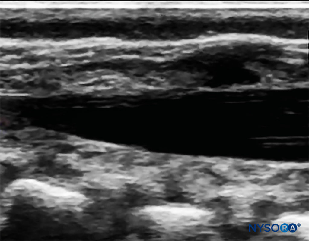 Pediatric Epidural and Spinal Anesthesia and Analgesia - NYSORA