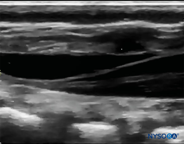 Pediatric Epidural and Spinal Anesthesia and Analgesia - NYSORA