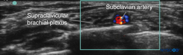 Peripheral Nerve Blocks for Children - NYSORA