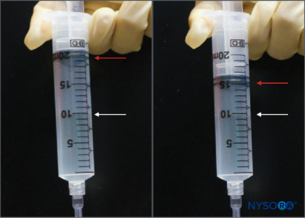 Monitoring, Documentation, and Consent for Regional Anesthesia ...