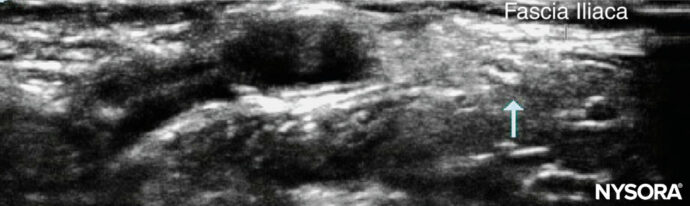 Peripheral Nerve Blocks for Children - NYSORA