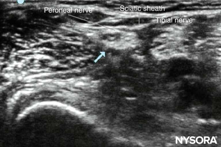 Peripheral Nerve Blocks for Children - NYSORA