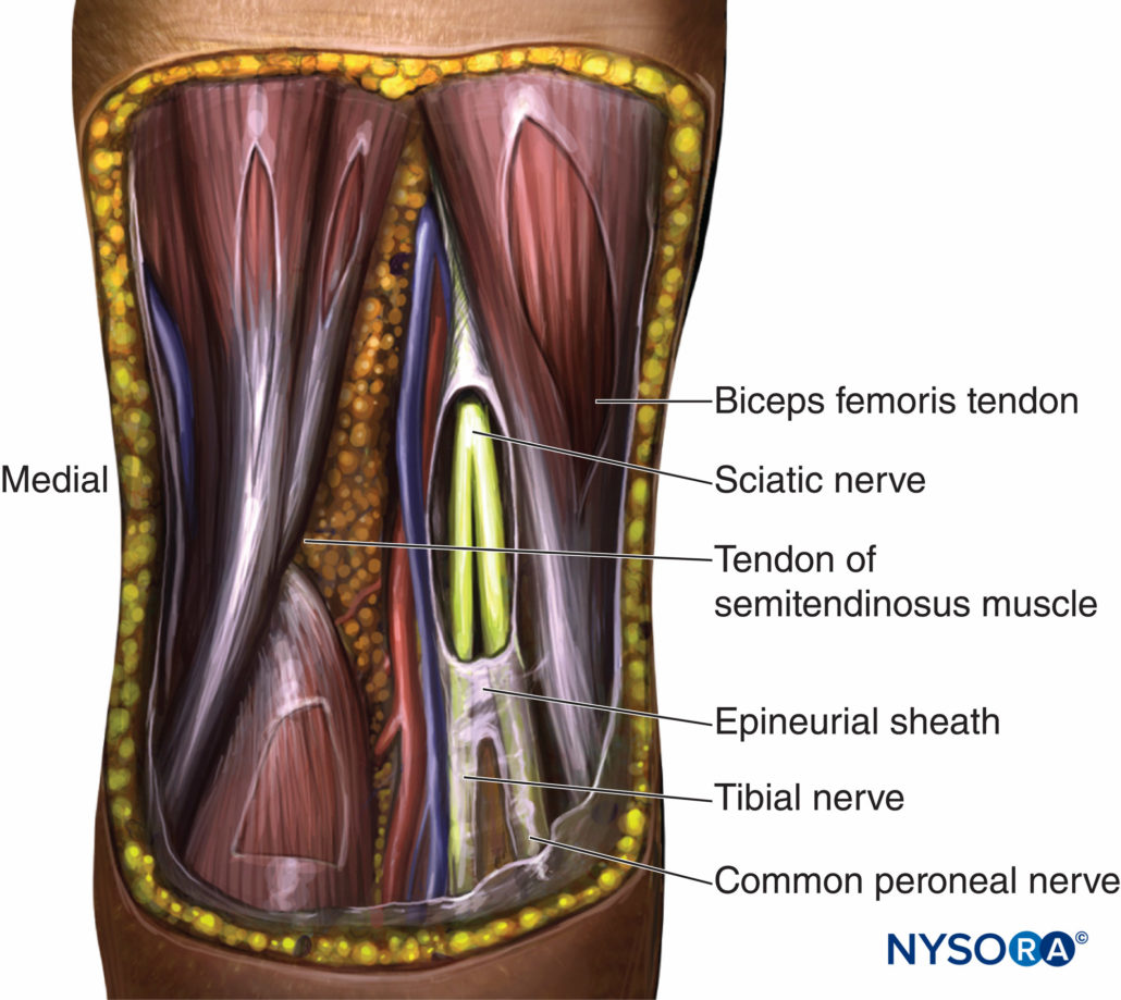 Popliteal Sciatic Nerve Block - Landmarks and Nerve Stimulator Technique - NYSORA
