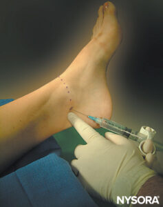 Ankle Block - Landmarks and Nerve Stimulator Technique - NYSORA