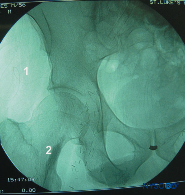 Sciatic Nerve Block - Landmarks and Nerve Stimulator Technique - NYSORA