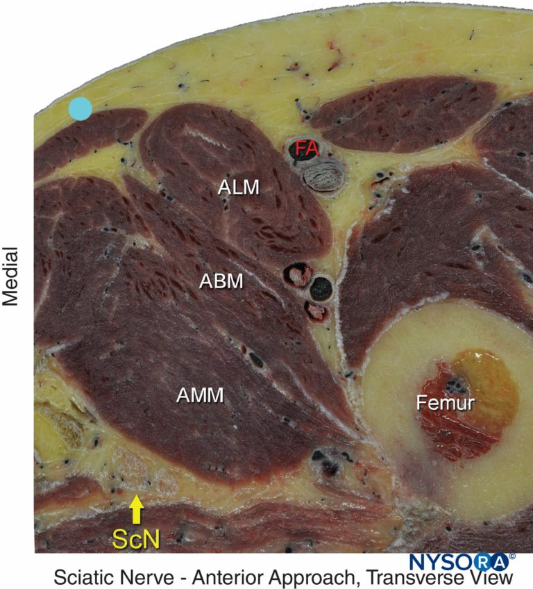 Ultrasound-Guided Sciatic Nerve Block - NYSORA