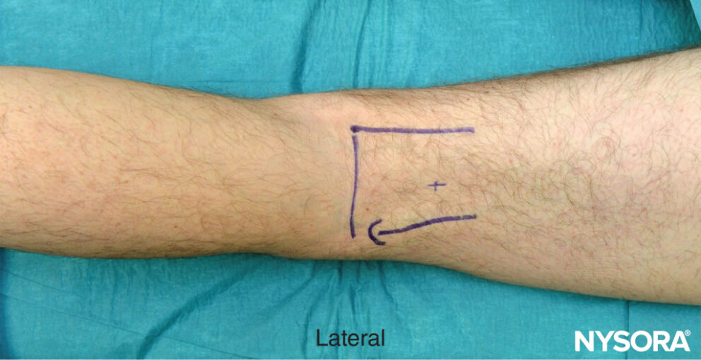 Popliteal Sciatic Nerve Block - Landmarks and Nerve Stimulator ...
