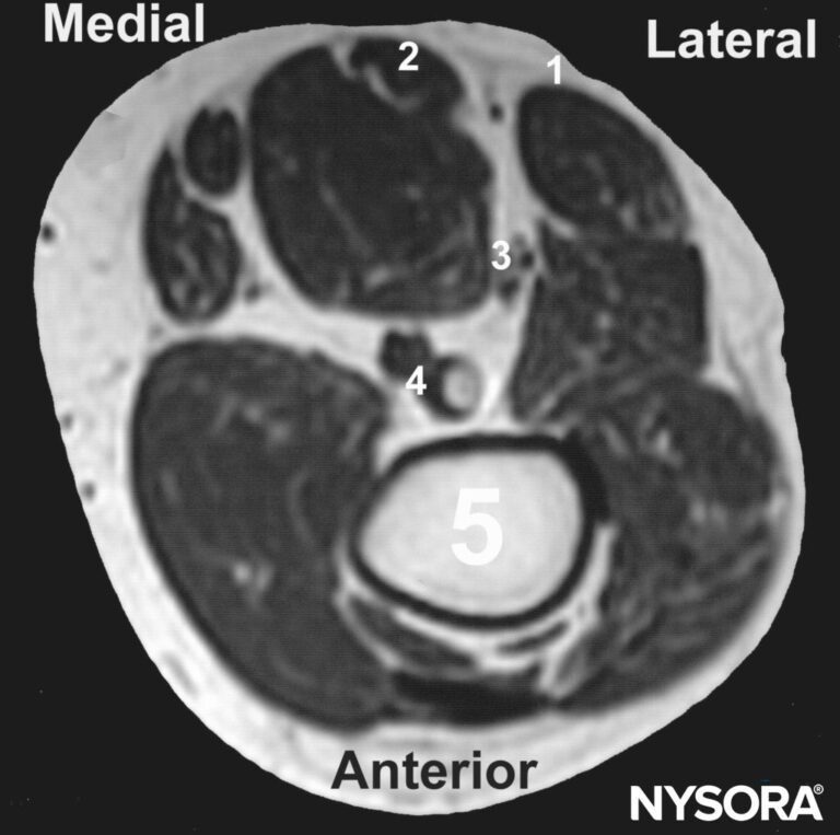 Popliteal Sciatic Nerve Block - Landmarks and Nerve Stimulator ...