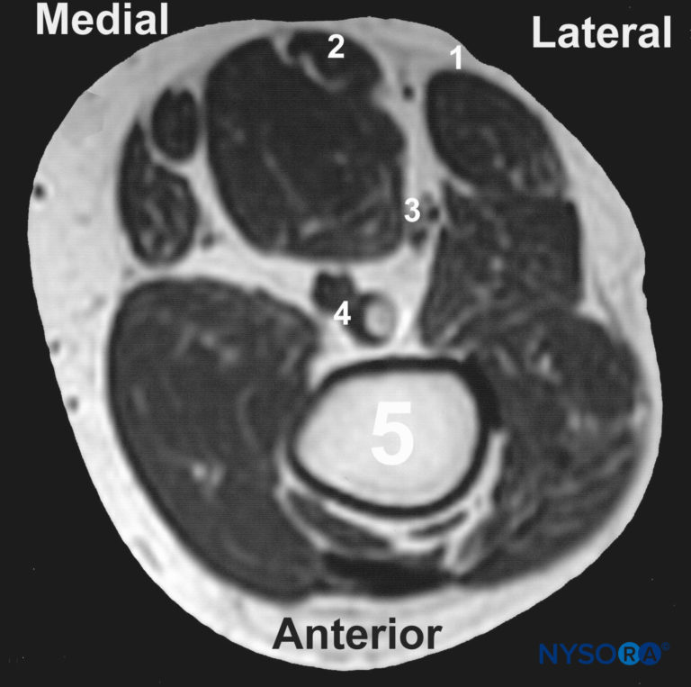Popliteal Sciatic Nerve Block - Landmarks and Nerve Stimulator ...