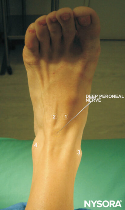 Ankle Block - Landmarks and Nerve Stimulator Technique - NYSORA