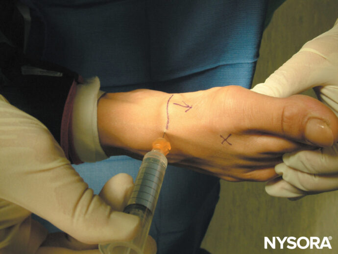 Ankle Block - Landmarks and Nerve Stimulator Technique - NYSORA