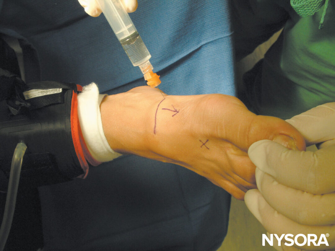 Ankle Block - Landmarks and Nerve Stimulator Technique - NYSORA