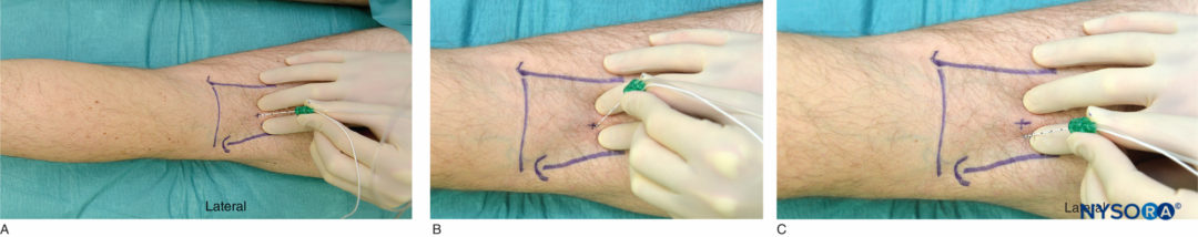 Popliteal Sciatic Nerve Block - Landmarks and Nerve Stimulator ...