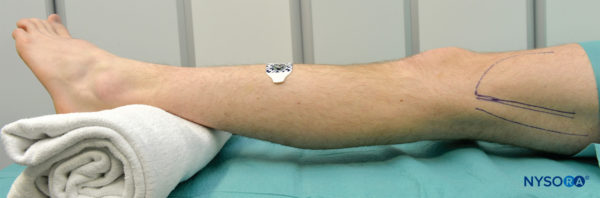 Popliteal Sciatic Nerve Block - Landmarks and Nerve Stimulator ...