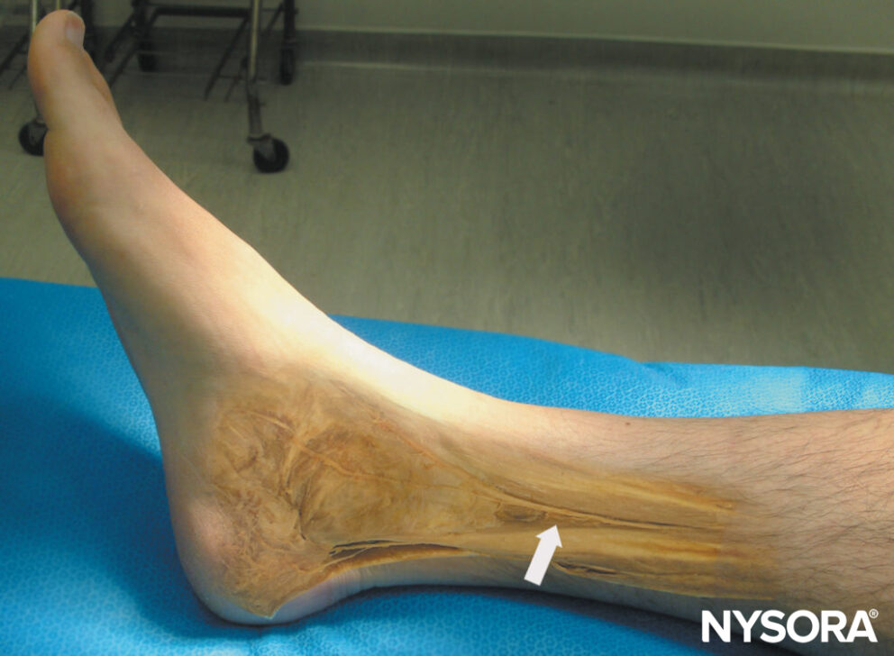 Ankle Block - Landmarks and Nerve Stimulator Technique - NYSORA
