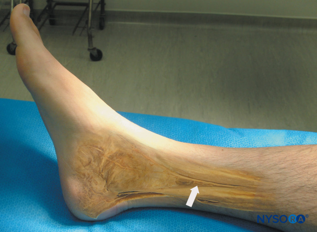 Ankle Block - Landmarks and Nerve Stimulator Technique - NYSORA