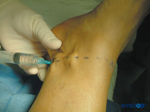 Ankle Block - Landmarks and Nerve Stimulator Technique - NYSORA