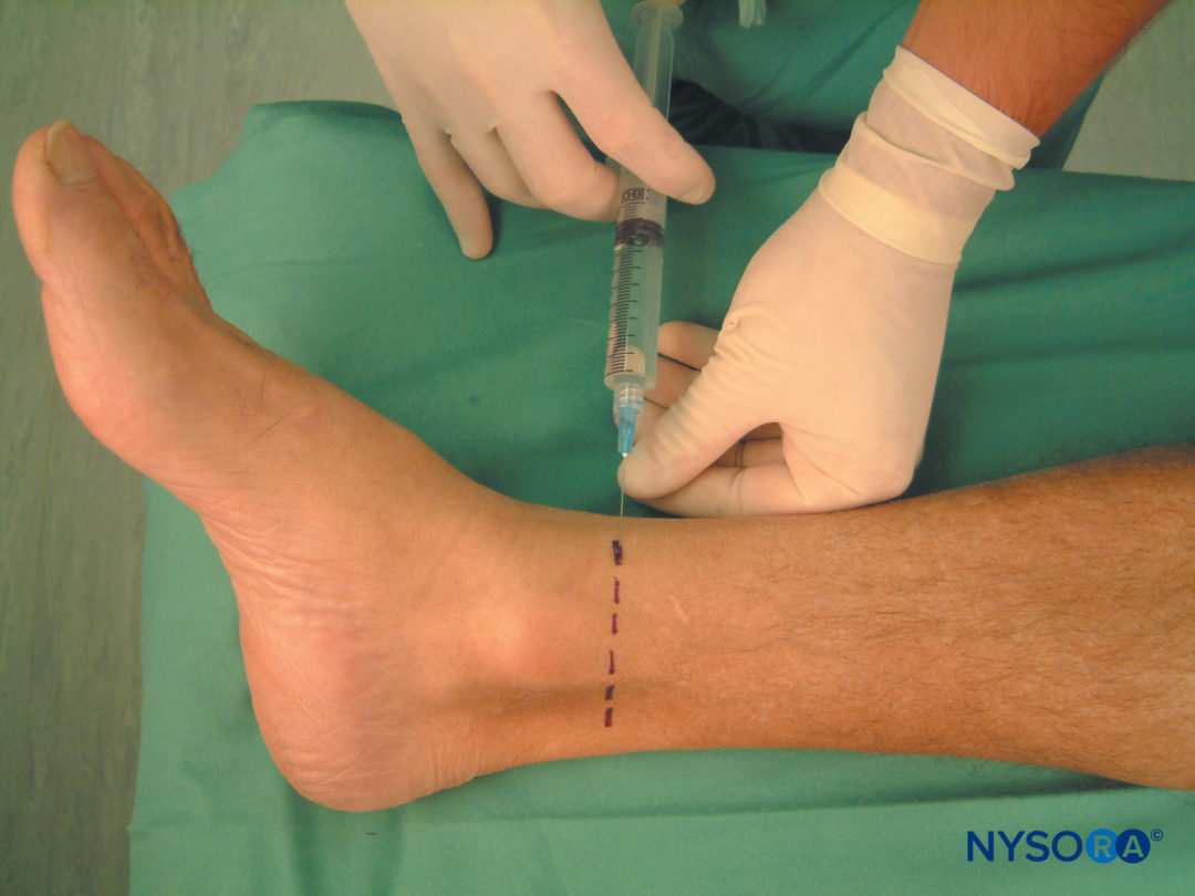 Cutaneous Nerve Blocks of the Lower Extremity - NYSORA
