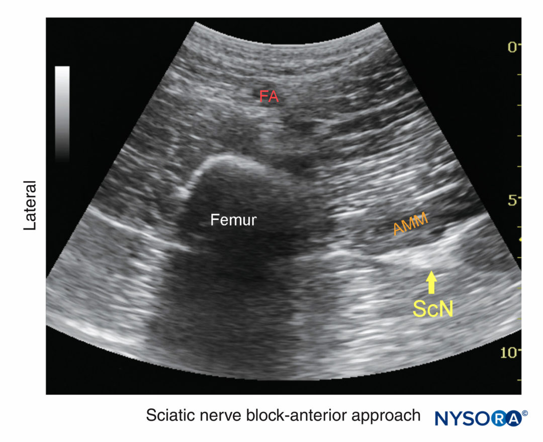Ultrasound-Guided Sciatic Nerve Block - NYSORA