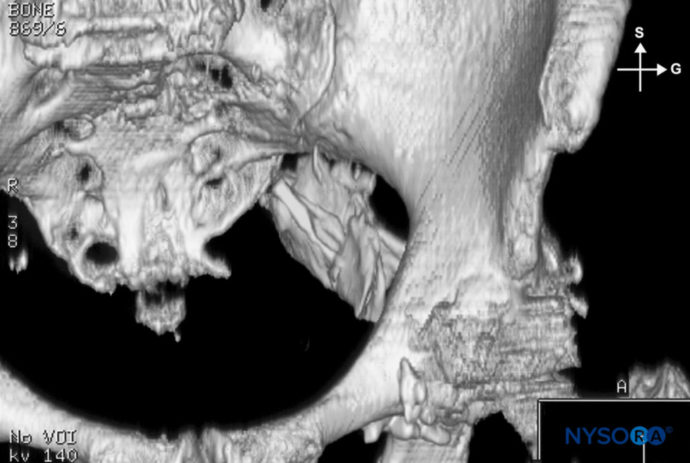 Sciatic Nerve Block - Landmarks and Nerve Stimulator Technique - NYSORA