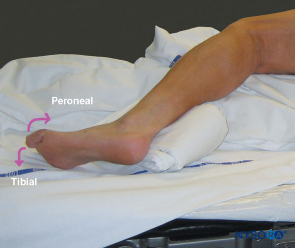Sciatic Nerve Block - Landmarks and Nerve Stimulator Technique - NYSORA
