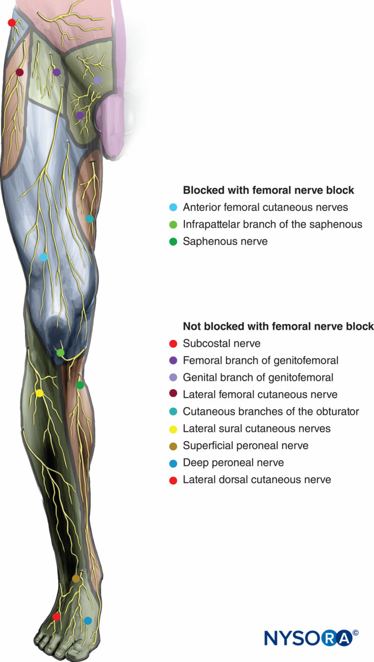 Femoral Nerve Block - Landmarks and Nerve Stimulator Technique - NYSORA