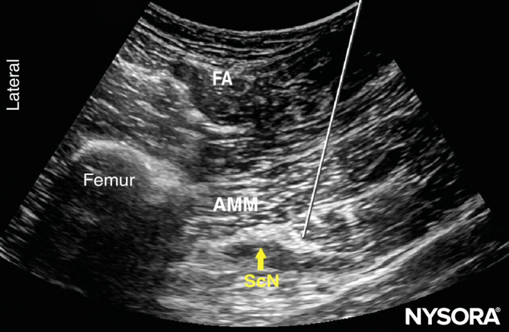 Ultrasound-Guided Sciatic Nerve Block - NYSORA