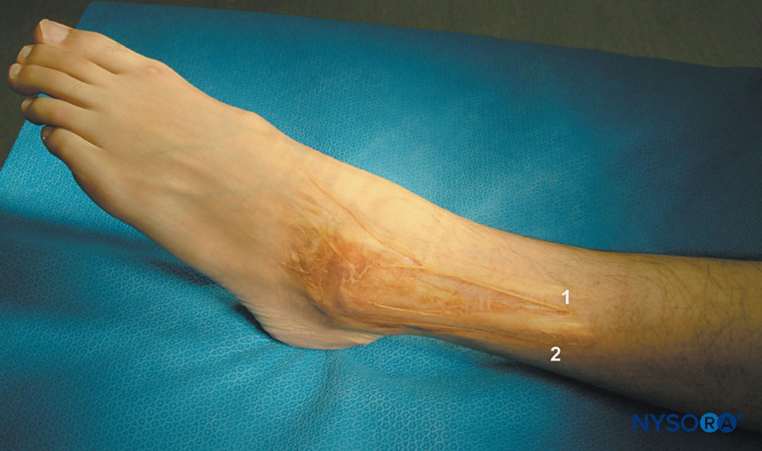 Ankle Block - Landmarks and Nerve Stimulator Technique - NYSORA