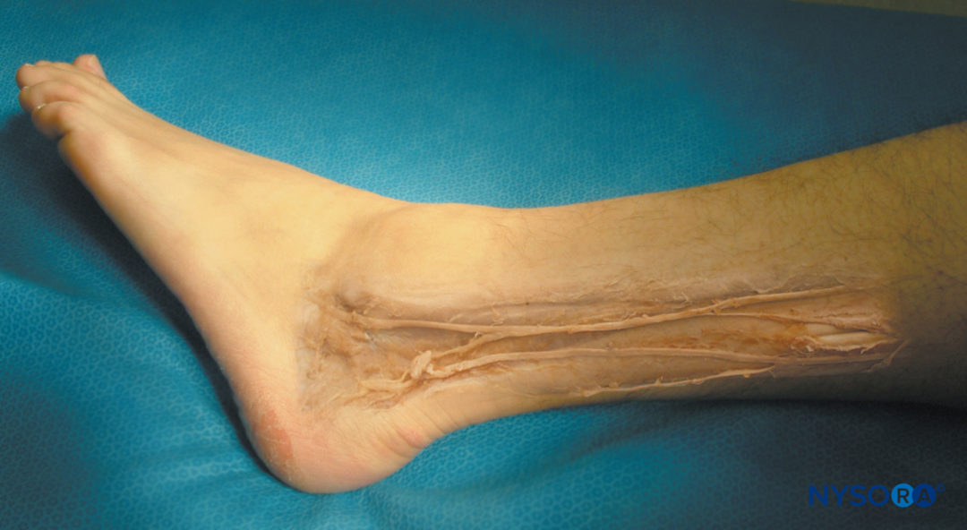 Ankle Block - Landmarks and Nerve Stimulator Technique - NYSORA