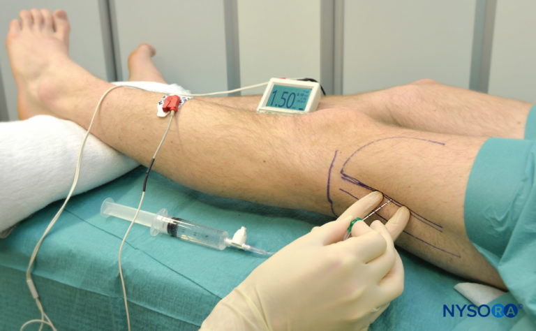 Blocco del nervo sciatico popliteo - Punti di riferimento e tecnica di ...