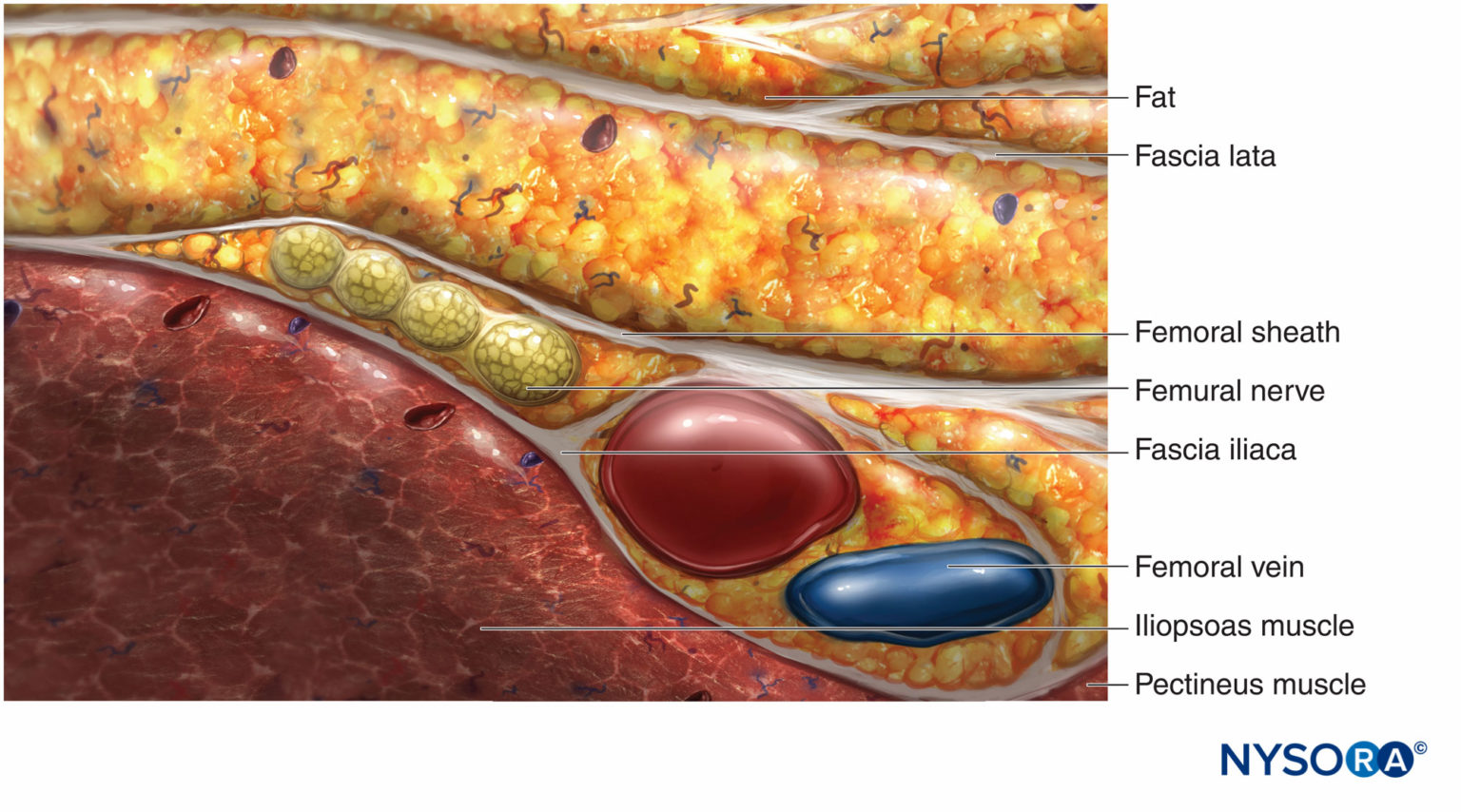 Femoral Nerve Block - Landmarks and Nerve Stimulator Technique - NYSORA