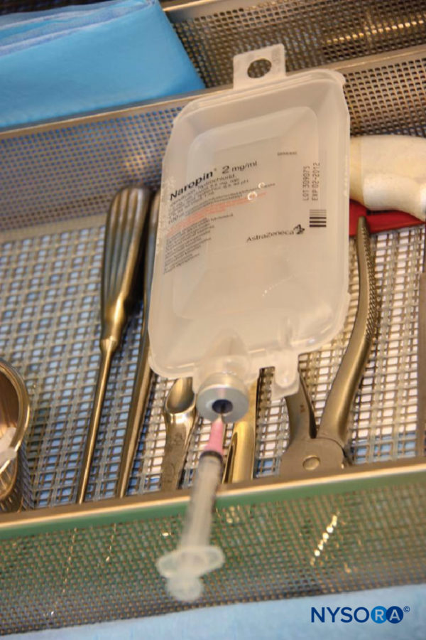 Intra-articular and Periarticular Infiltration of Local Anesthetics ...