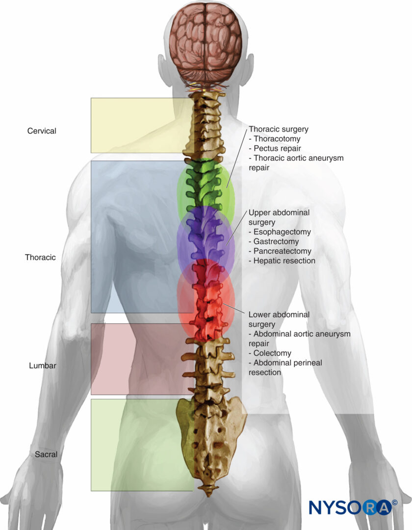 Epidural Anesthesia And Analgesia Nysora