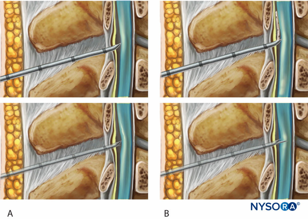 Combined Spinal-Epidural Anesthesia - NYSORA
