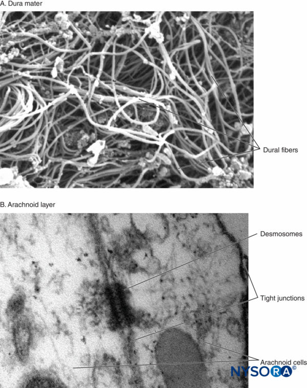 Postdural Puncture Headache - NYSORA