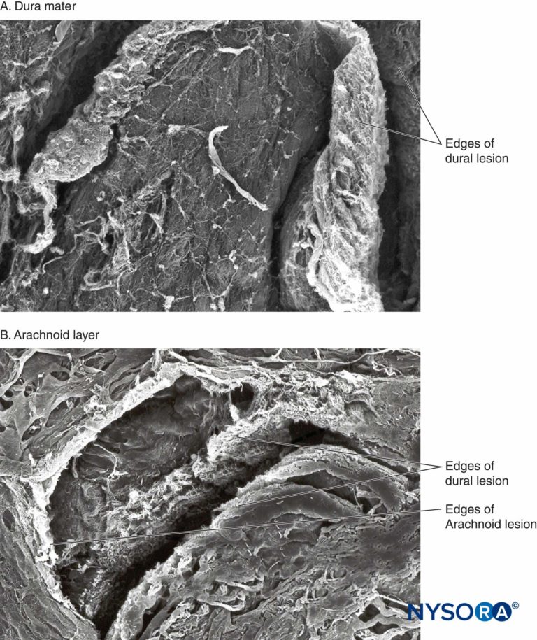 Postdural Puncture Headache - NYSORA