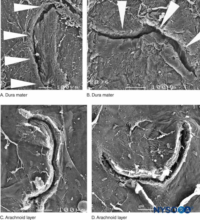 Postdural Puncture Headache - NYSORA