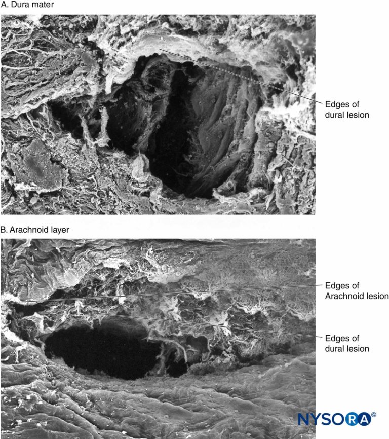 Postdural Puncture Headache - NYSORA