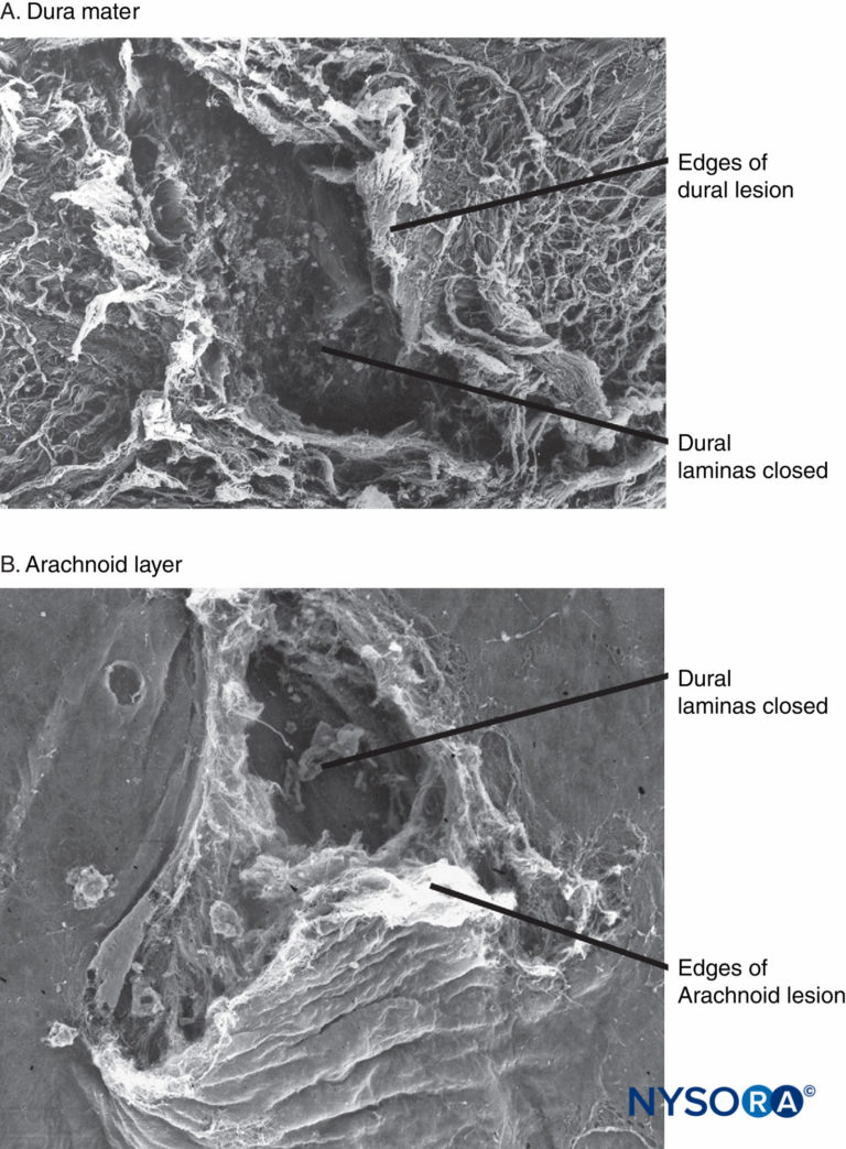 Postdural Puncture Headache - NYSORA