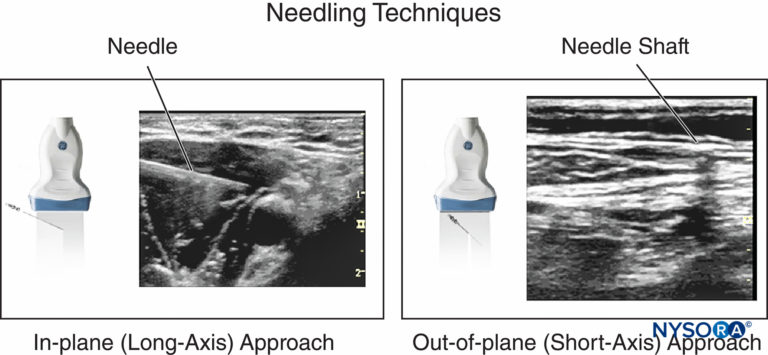 Optimizing an Ultrasound Image - NYSORA
