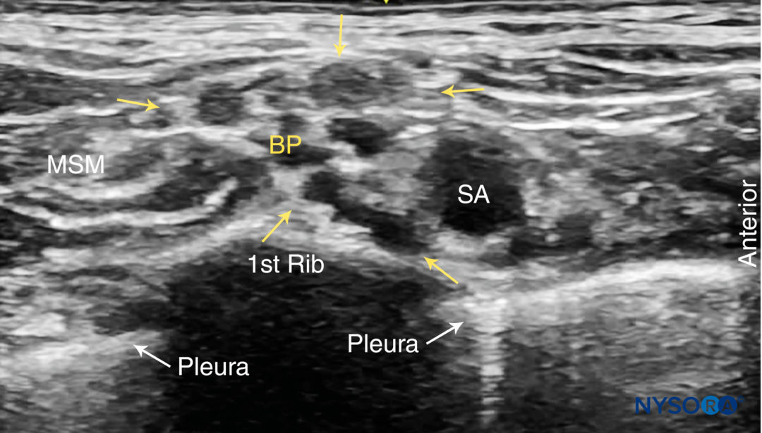 Ultrasound-Guided Supraclavicular Brachial Plexus Nerve Block - NYSORA