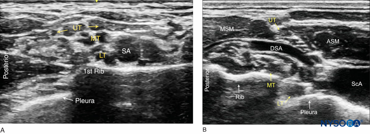 Ultraschallgeführte supraklavikuläre Blockade des Plexus brachialis ...