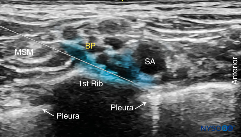 Ultrasound-Guided Supraclavicular Brachial Plexus Nerve Block - NYSORA